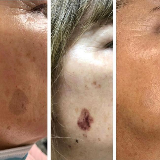 Brown Spots Removal | Age Spot Treatments Brown Spots Removal | Age Spot Treatments
